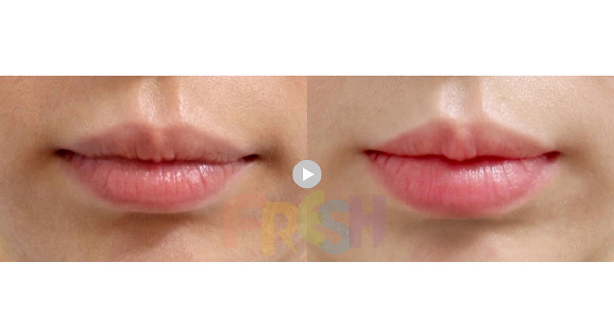 [Petit Surgery]Filler_Lip&Lip corner : Fresh Plastic Surgery / Petit ...