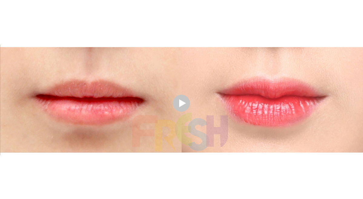 [Petit Surgery]Filler_Lip&Lip corner : Fresh Plastic Surgery / Petit ...