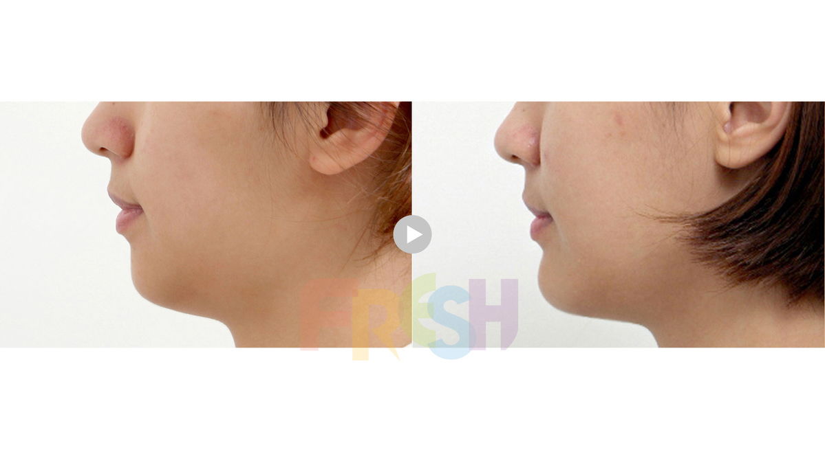 [Petit Surgery]Filler_Chin : Fresh Plastic Surgery / Petit ...