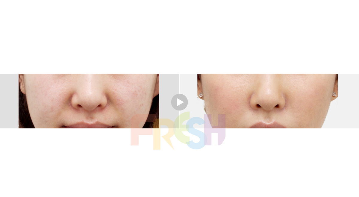 [Petit Surgery]Filler_Paranasal Fold : Fresh Plastic Surgery / Petit ...