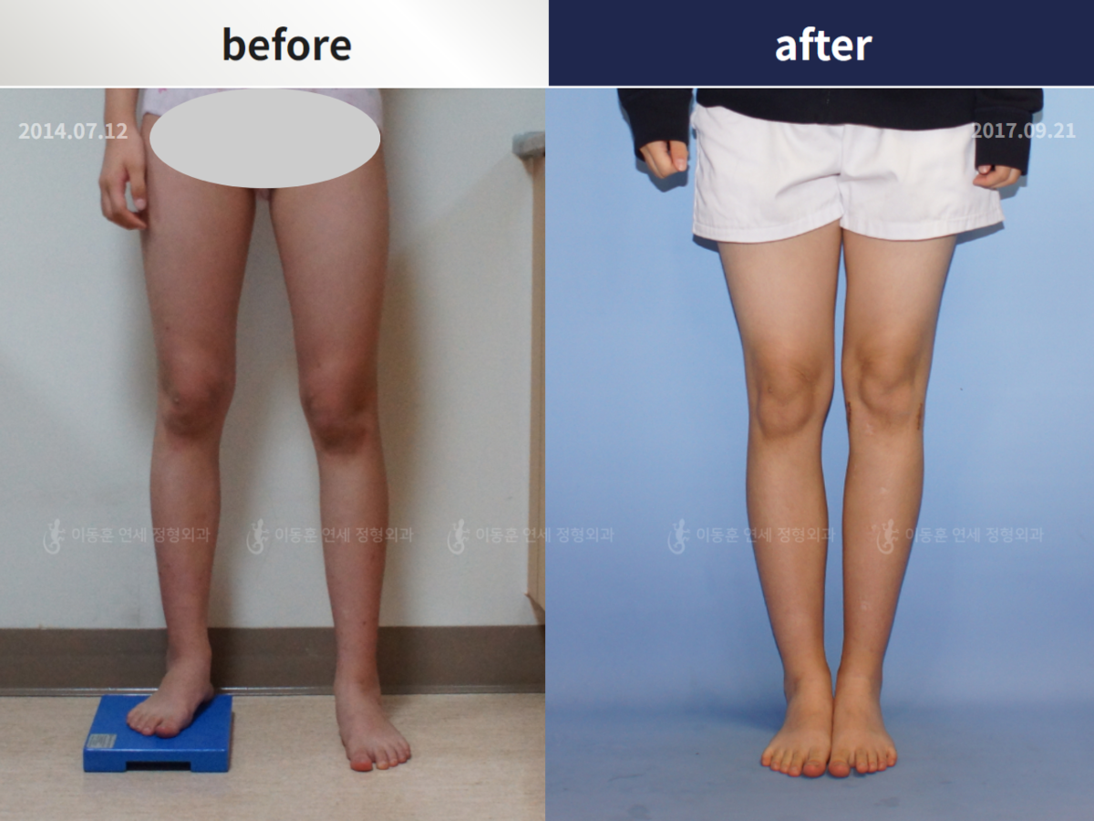 Pediatric Leg Length Discrepancy : Pediatric , Adolescent LLD