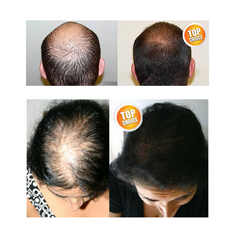 Rejen/รีเจน แฮร์ โซลูชั่น ลดผมร่วง ศีรษะล้าน 70ml : นิโกะ นิโกะ มาร์เก็ต/ตัวแทนจัดซื้อและจัดส่ง ...