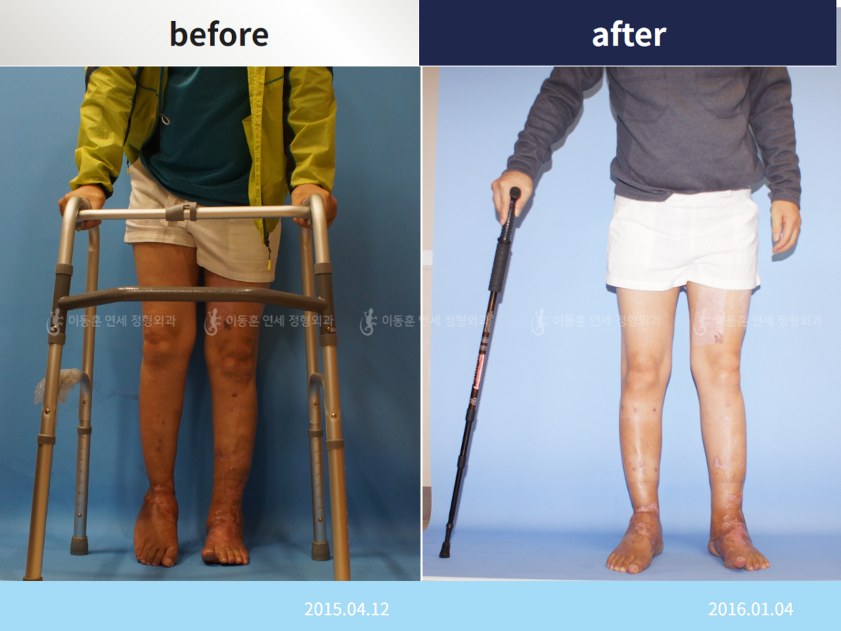 Post-trauma deformity : LLD + ankle/foot deformity : Post-trauma deformity