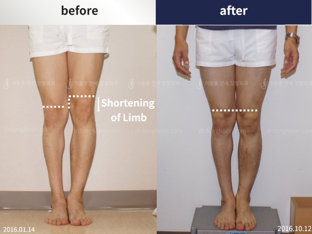Shortening of Bone (3cm) Shortening for treatment of Leg Length ...