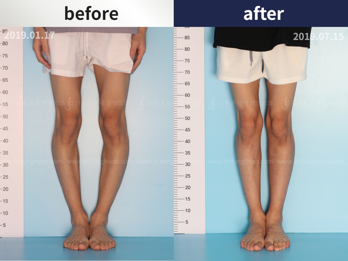 Adult Bowlegs : Adult Bowlegs