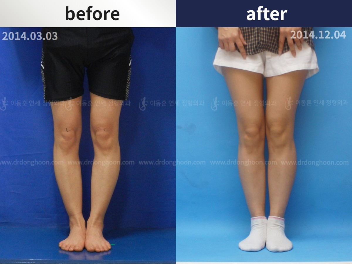 Adult Bowlegs : Adult Bowlegs