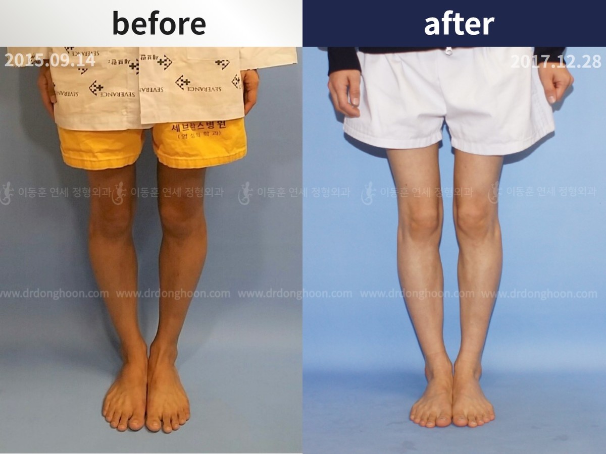 Adult Bowlegs : Adult Bowlegs