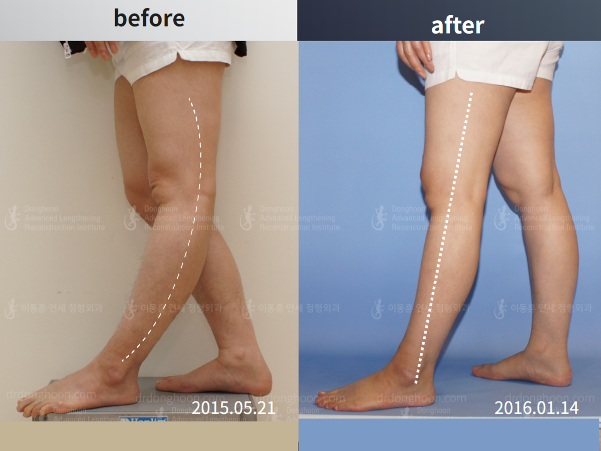 Genu Recurvatum : Genu Recurvatum