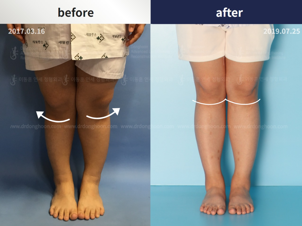 Rickets- Tibial lengthening+Rotational deformity correction ...