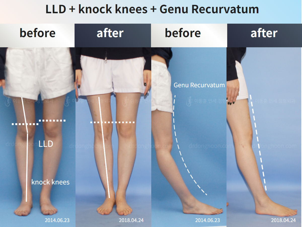 Leg Length Discrepancy + Genu Recurvatum + Knock Knees correction ...