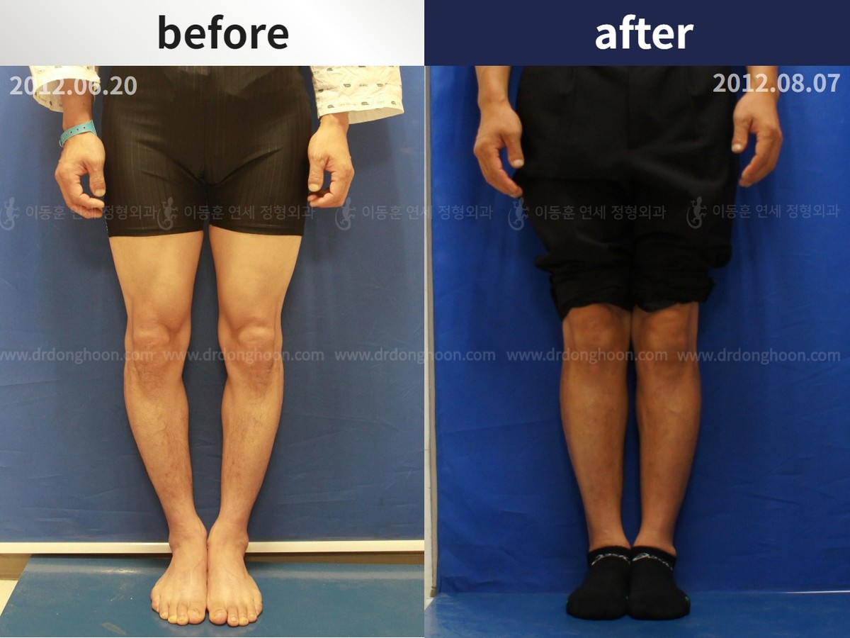 Adult Bowlegs : Adult Bowlegs