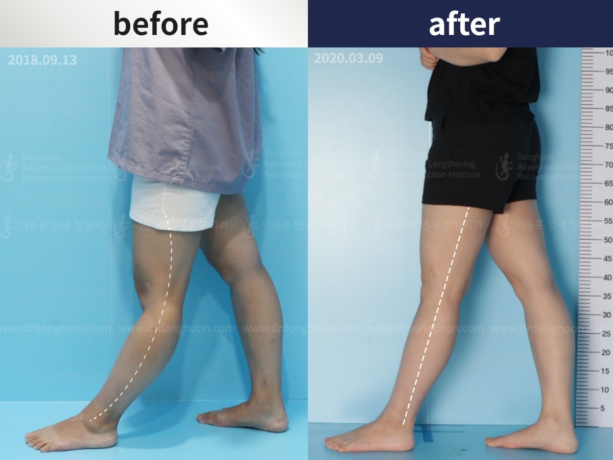 Genu Recurvatum : Genu Recurvatum