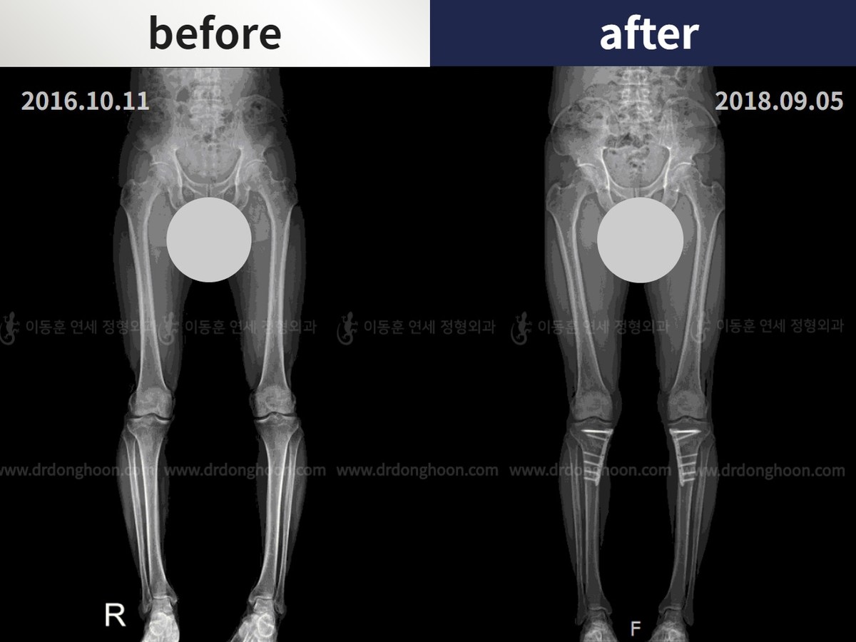 Adult Bowlegs : Adult Bowlegs