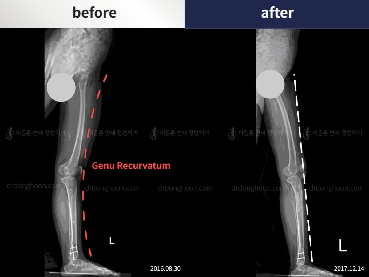 Genu Recurvatum : Genu Recurvatum