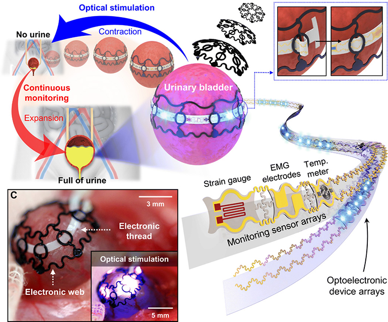 Implantable Bladder Wrap for Improved Urinary Control : 제품관련뉴스