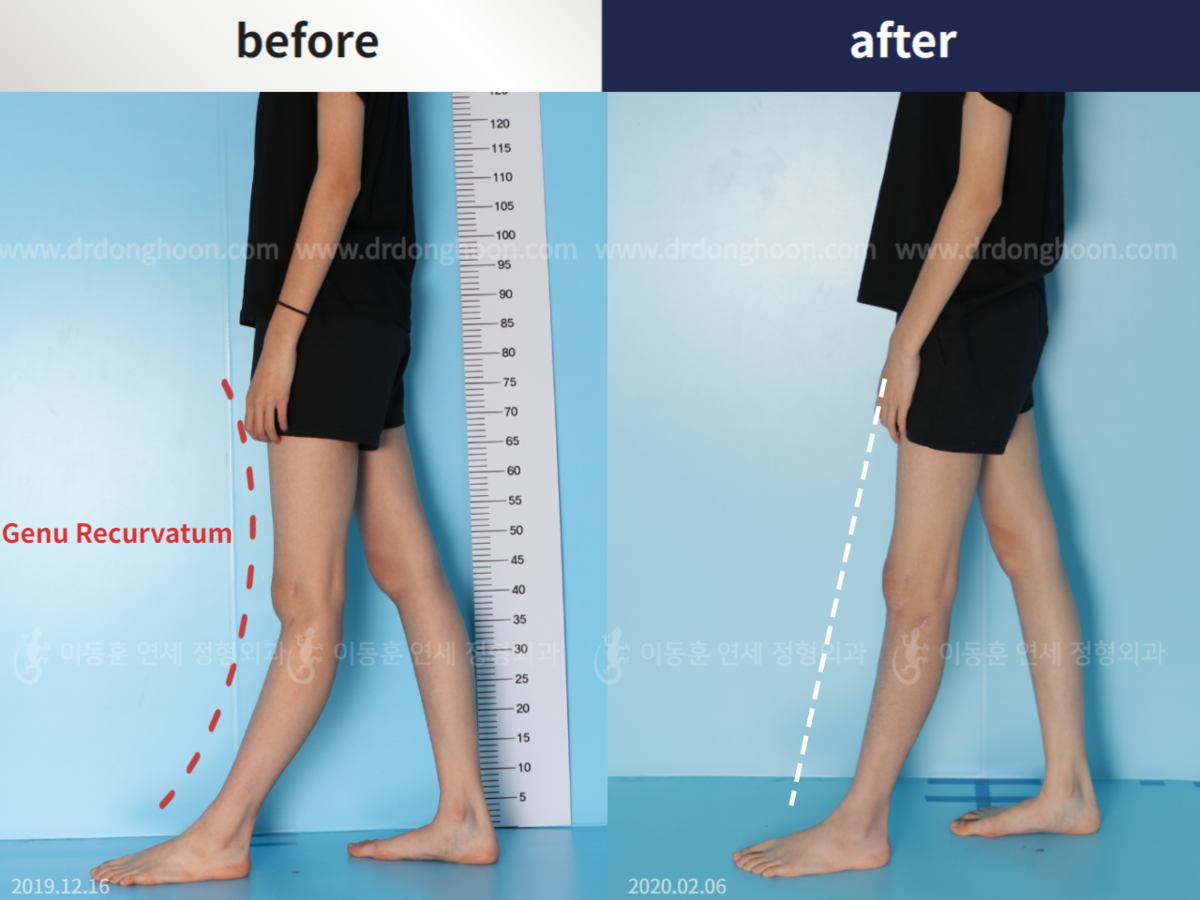 Genu Recurvatum : Genu Recurvatum