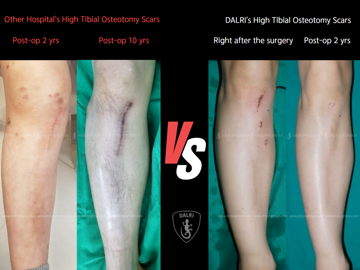 Other Hospital's High Tibial Osteotomy Scars VS DALRI's High Tibial ...