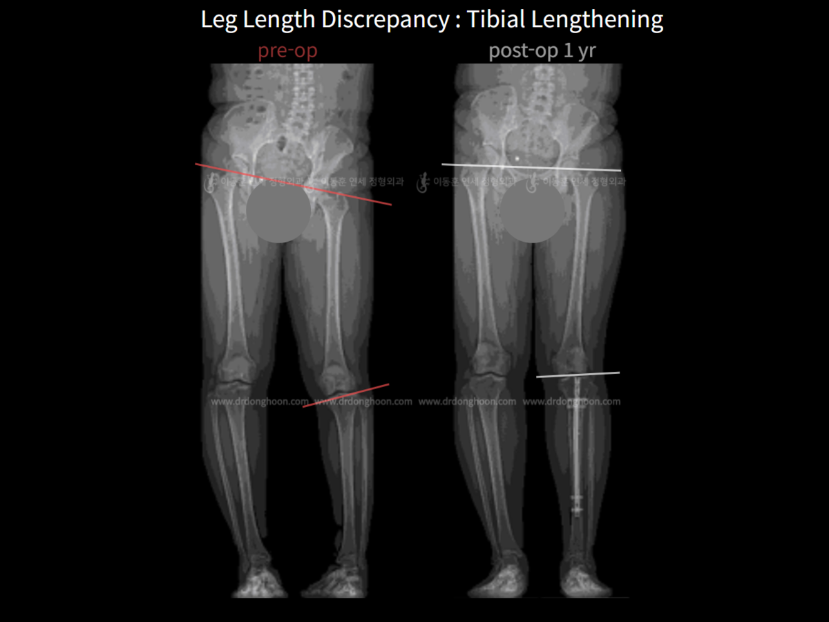 Leg Length Discrepancy : Tibial Lengthening : Adult LLD