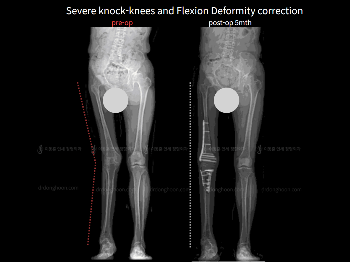 Severe knock-knees and Flexion Deformity correction : Adult knock knees