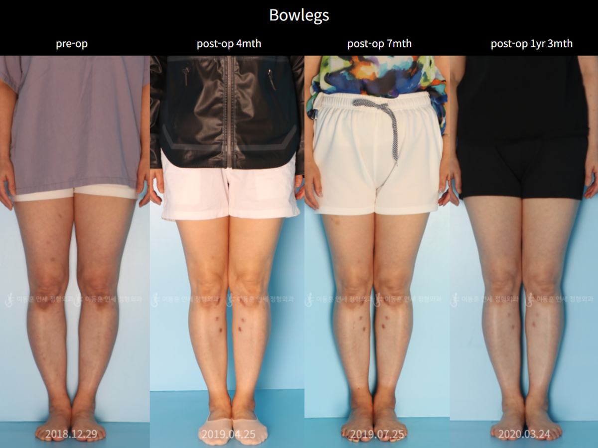 Bowlegs : Adult Bowlegs
