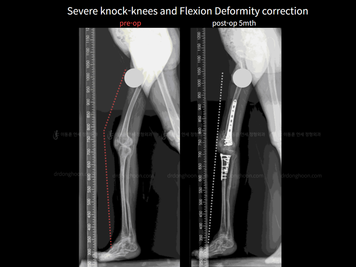Severe knock-knees and Flexion Deformity correction : Flexion Deformity