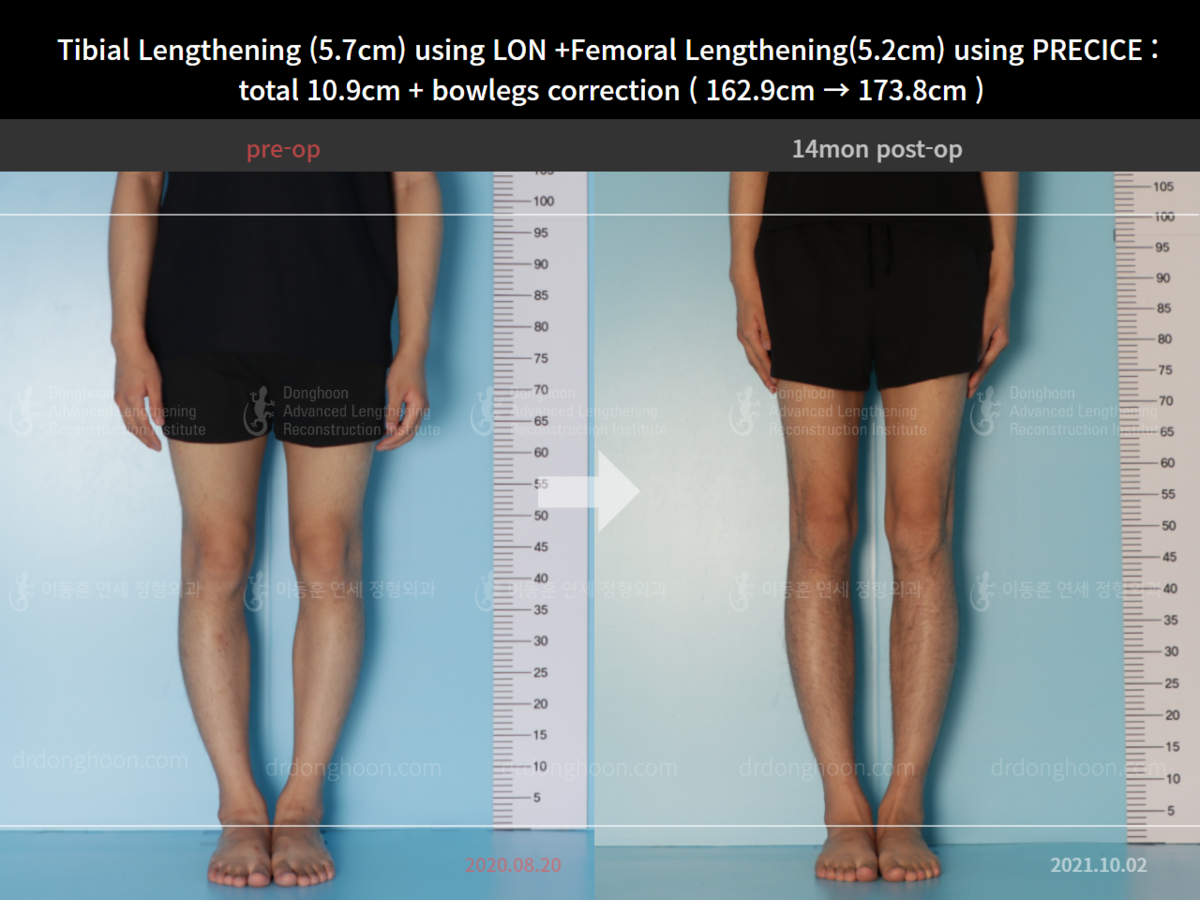 Tibial Lengthening (5.7cm) using LON +Femoral Lengthening(5.2cm) using PRECICE : total 10.9cm ...