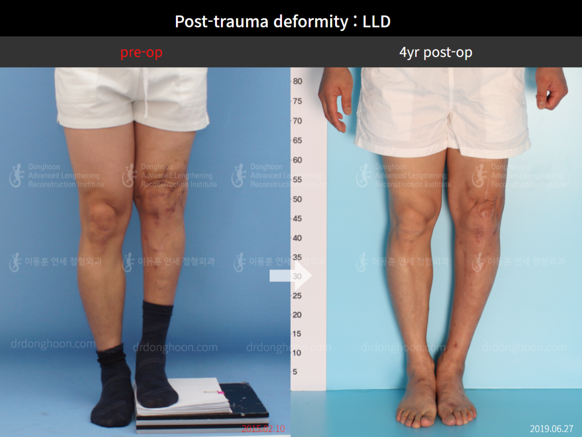 Post-trauma deformity : LLD : Post-trauma deformity