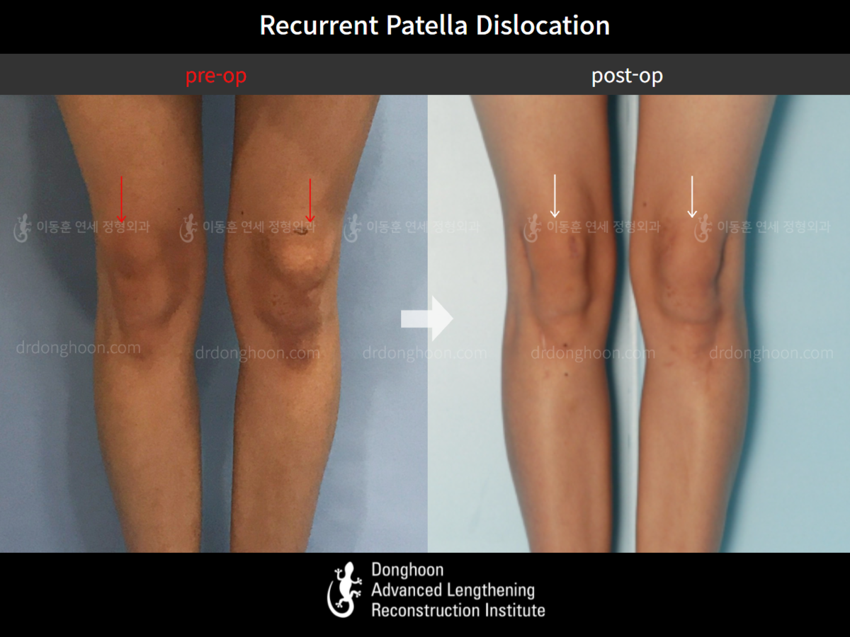 Recurrent Patella Dislocation : Recurrent Patella Dislocation