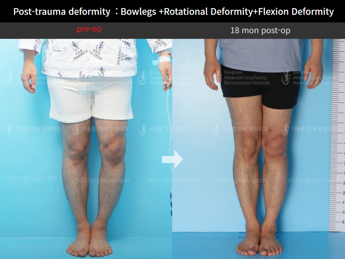 Post-traumatic Deformity (Left : Bowlegs + Rotational deformity ...