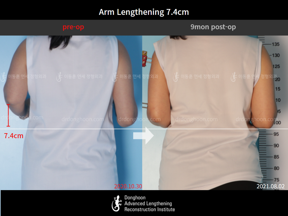 Arm Lenthening 7.4cm : Arm Lengthening