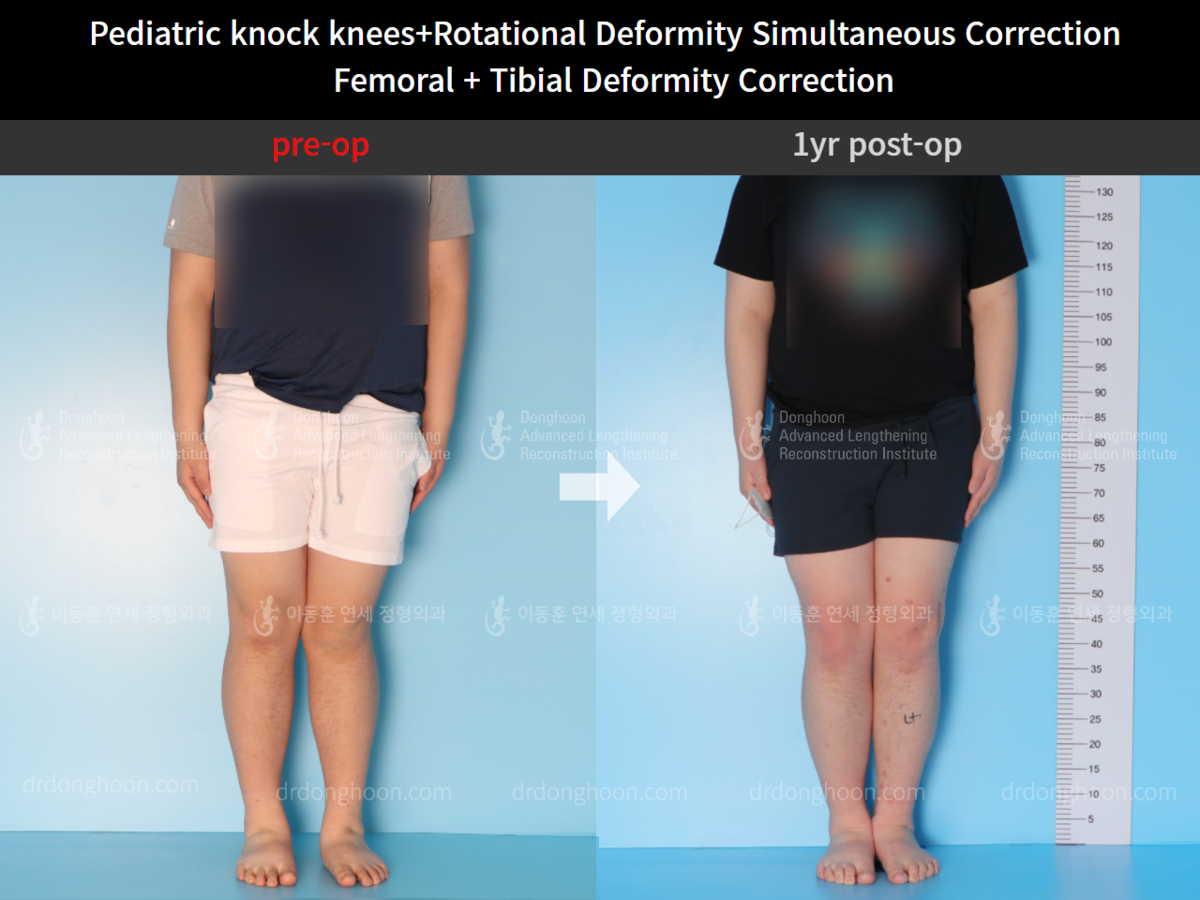 Pediatric knock knees+Rotational Deformity Simultaneous Correction ...