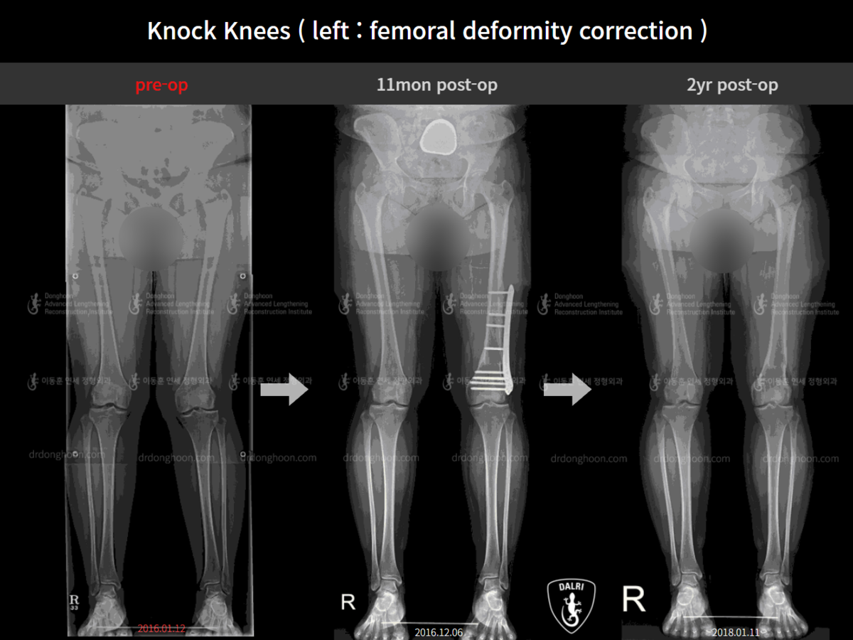 Knock Knees ( left : femoral deformity correction ) : Adult knock knees