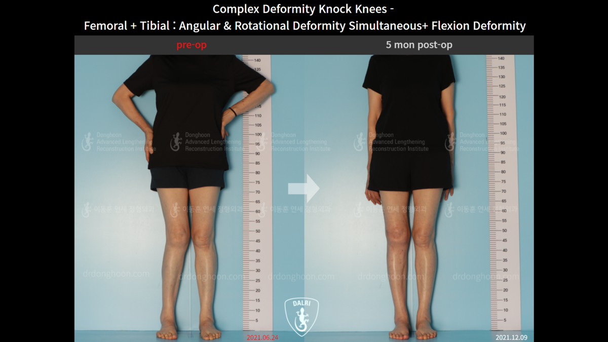 Complex Deformity Knock Knees - Femoral + Tibial : Angular & Rotational ...