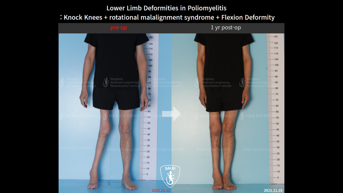 Lower Limb Deformities in Poliomyelitis : Knock Knees + rotational ...