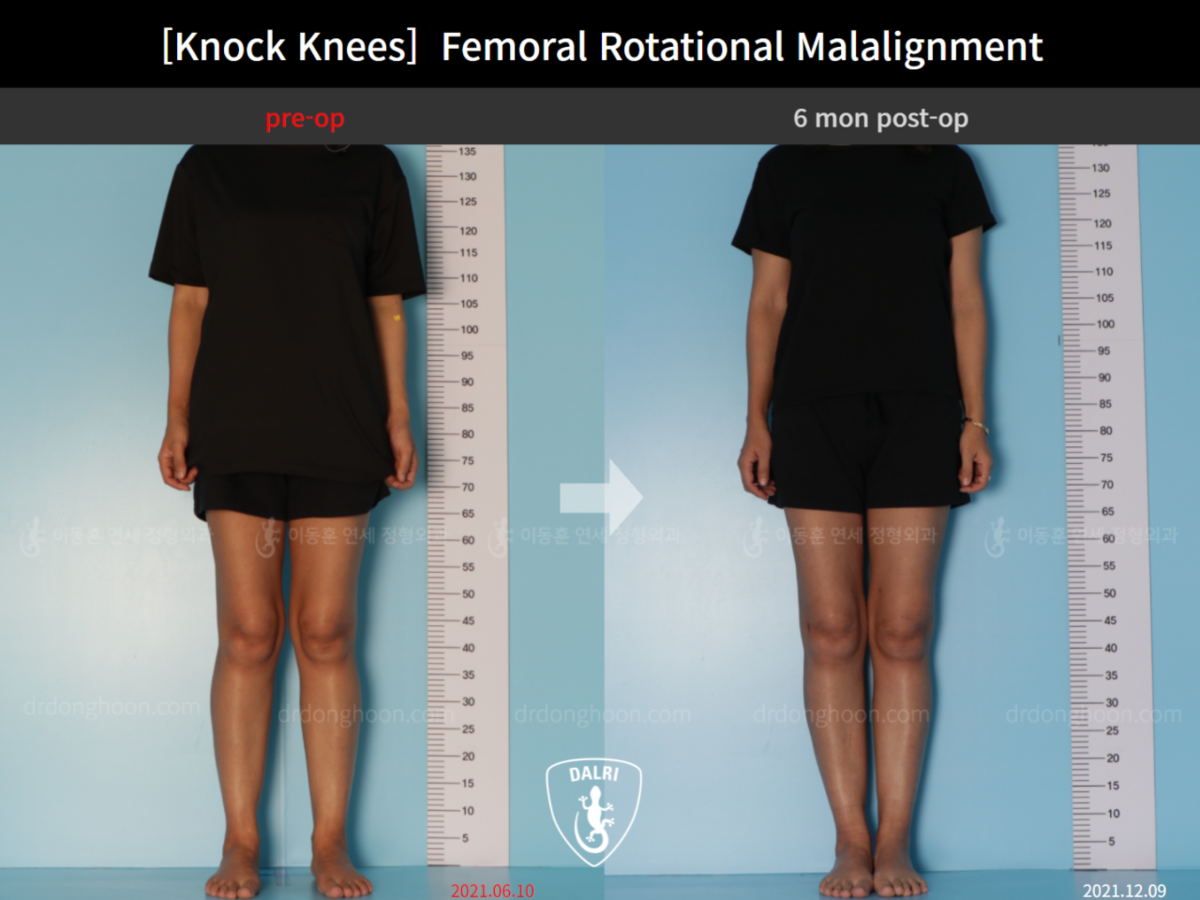 [Knock Knees] Femoral Rotational Malalignment : Adult knock knees
