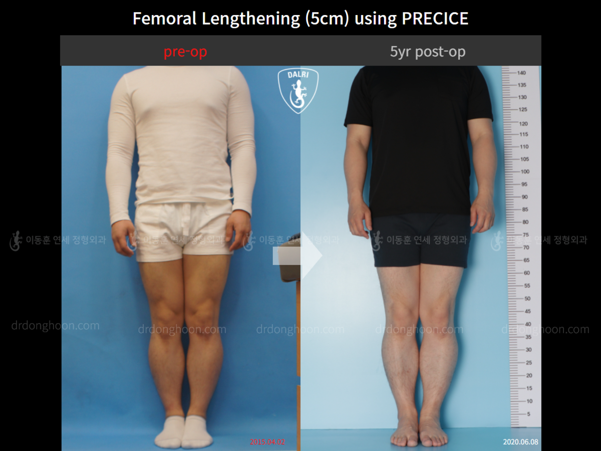 Femoral Lengthening (5cm) using PRECICE : CLL PRECICE