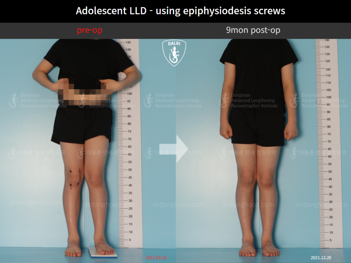 Adolescent LLD - using epiphysiodesis screws : Pediatric , Adolescent LLD