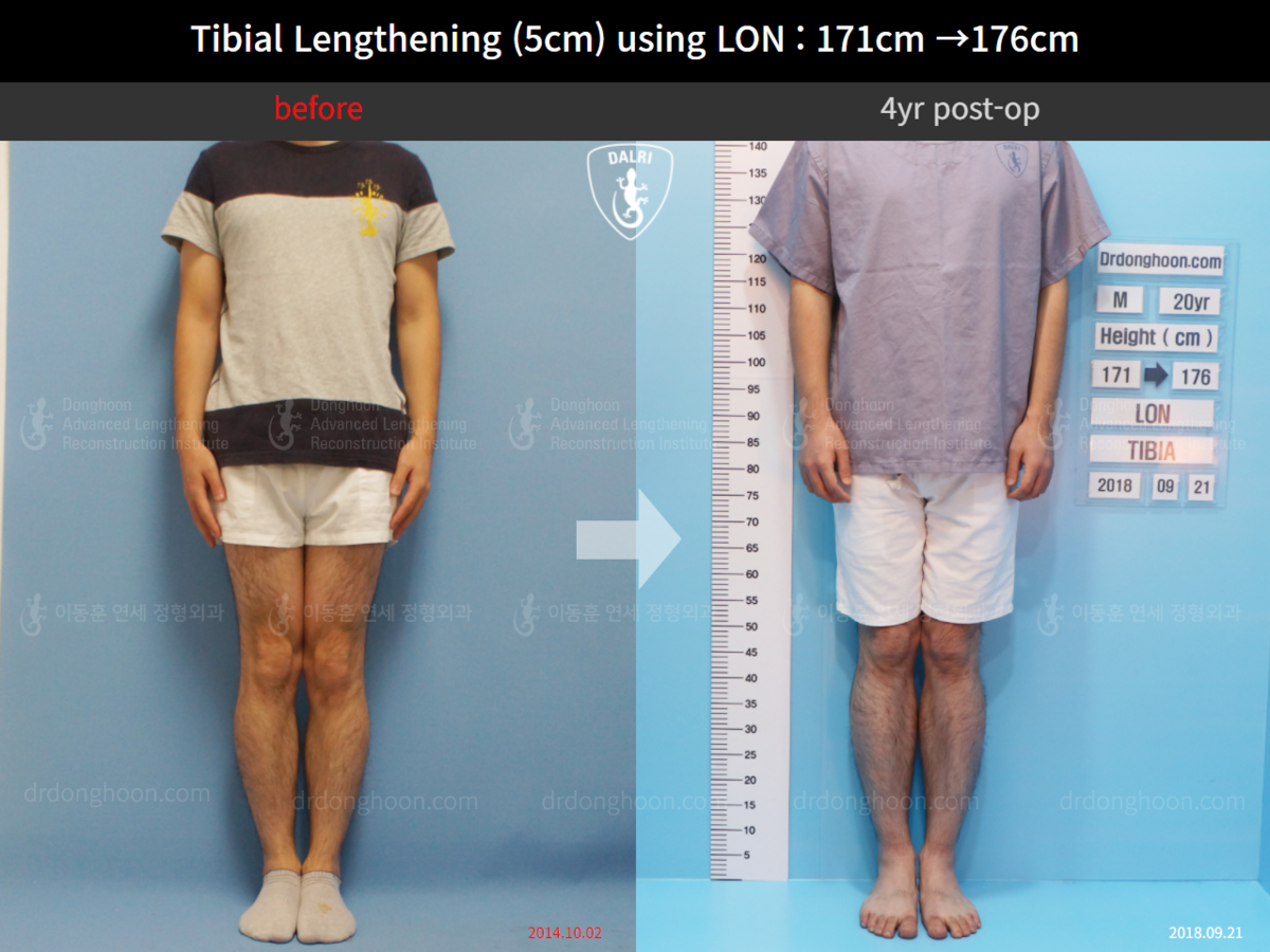 Tibial Lengthening (5cm) using LON : 171cm →176cm : DALRI before & after