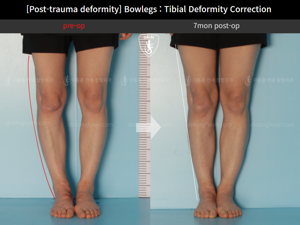 [Post-trauma deformity] Bowlegs : Tibial Deformity Correction : Post ...
