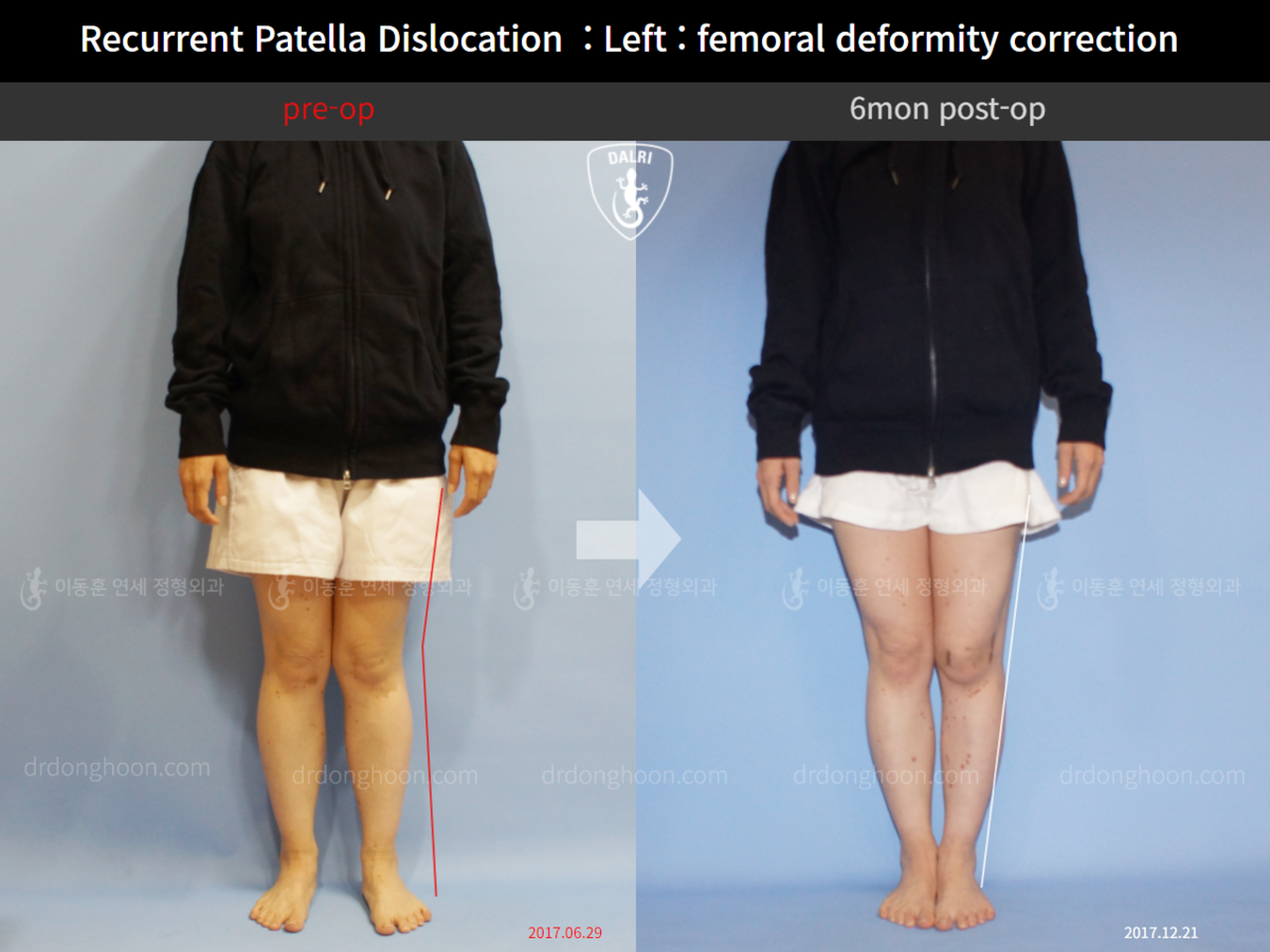 Recurrent Patella Dislocation : Left : femoral deformity correction ...