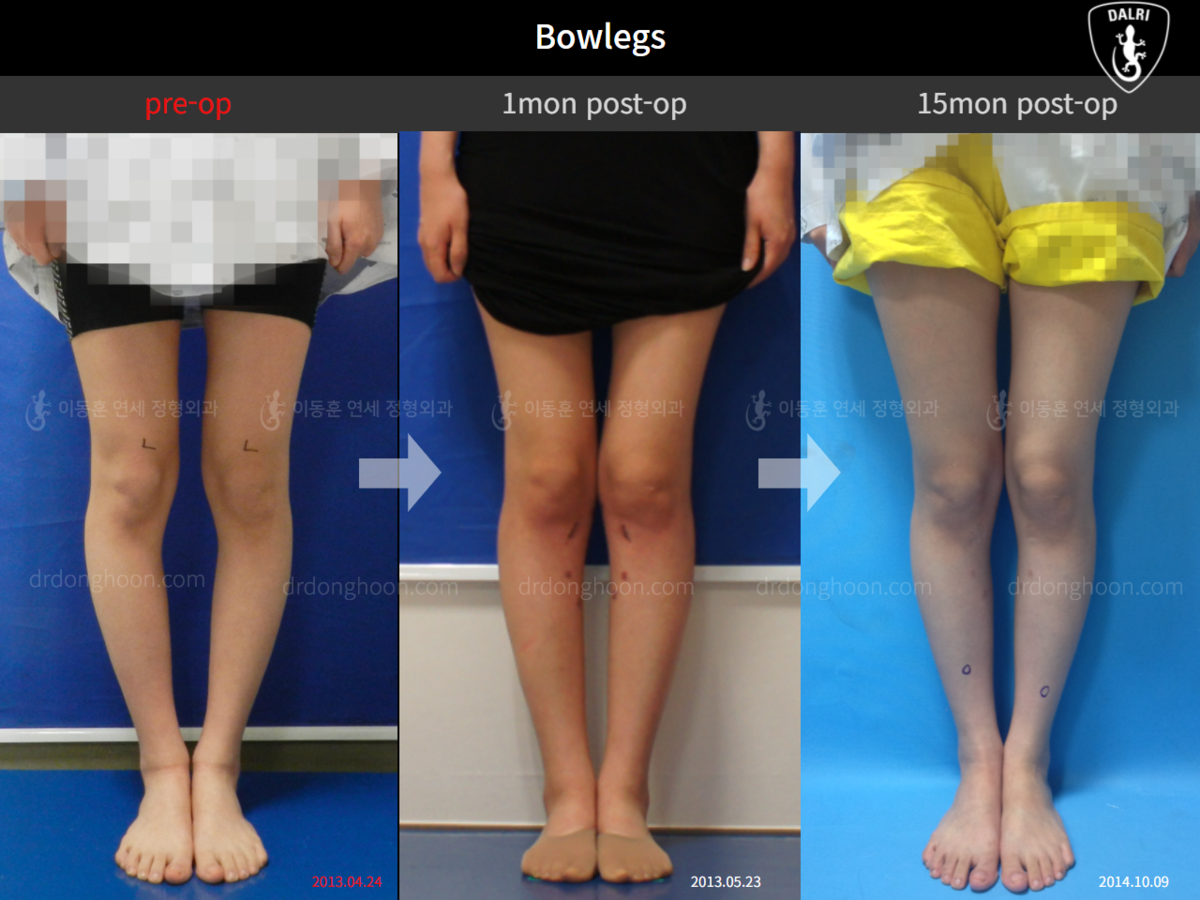 Adult Bowlegs : Adult Bowlegs