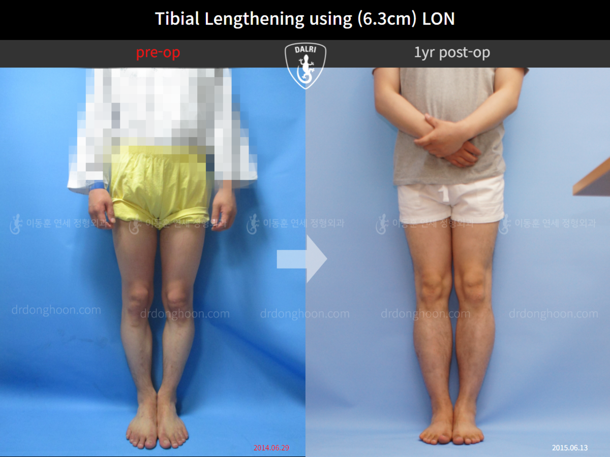 Tibial Lengthening using (6.3cm) LON : DALRI before & after