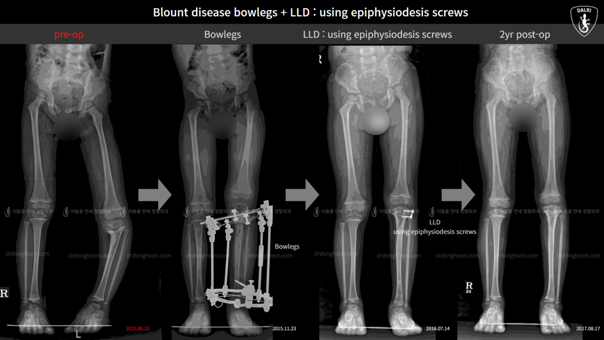Blount disease bowlegs + LLD : using epiphysiodesis screws : Pediatric ...