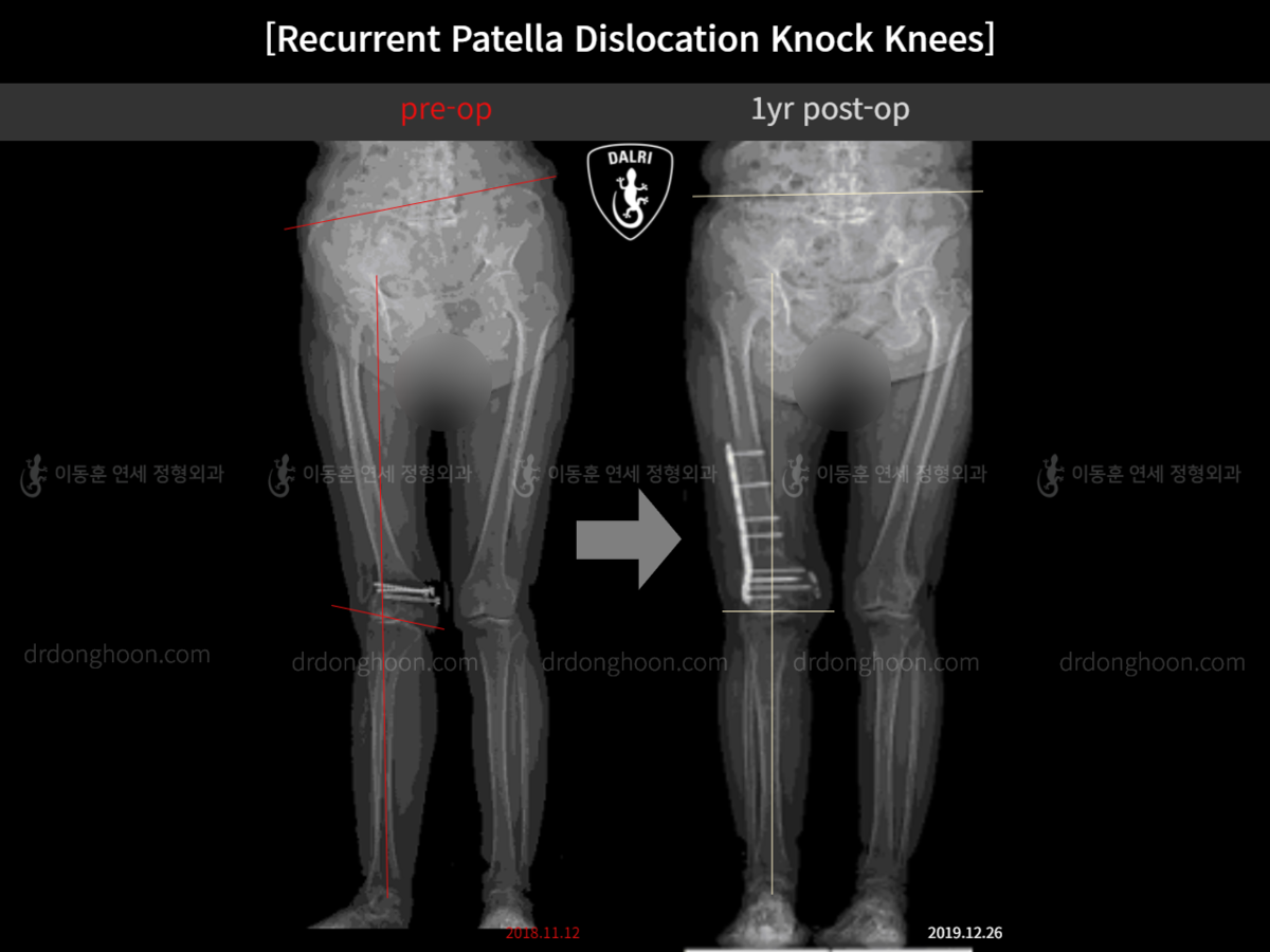 [Recurrent Patella Dislocation Knock Knees] : Adult knock knees