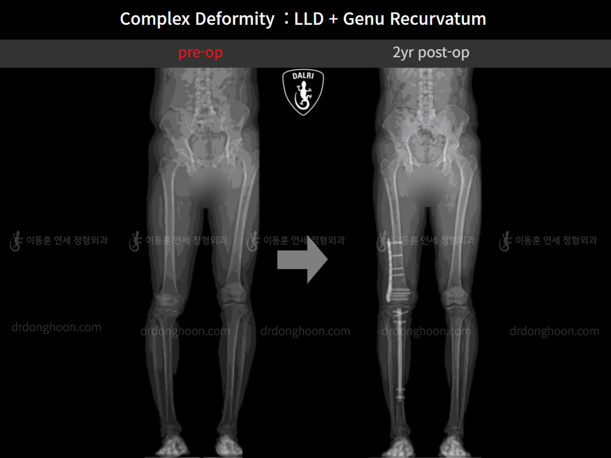 Complex Deformity : LLD + Genu Recurvatum : Adult LLD