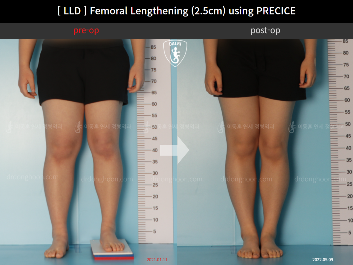 [ LLD ] Femoral Lengthening (2.5cm) using PRECICE : Adult LLD
