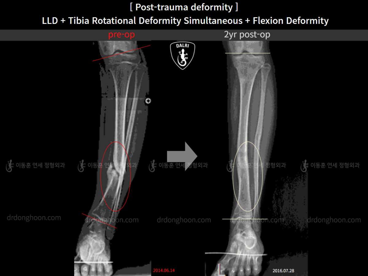 [ Post-trauma deformity ] LLD + Tibia Rotational Deformity Simultaneous ...