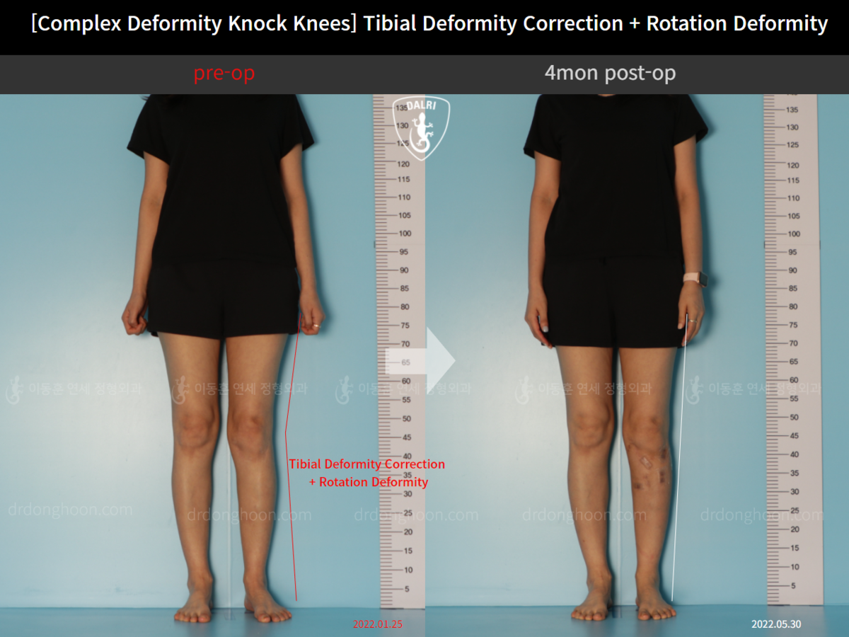 [Complex Deformity Knock Knees] Tibial Deformity Correction + Rotation ...