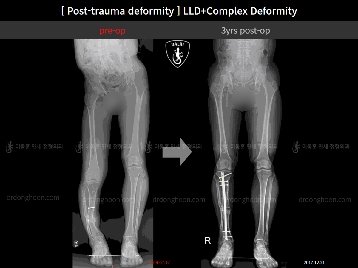 [ Post-trauma deformity ] LLD+Complex Deformity : Post-trauma deformity