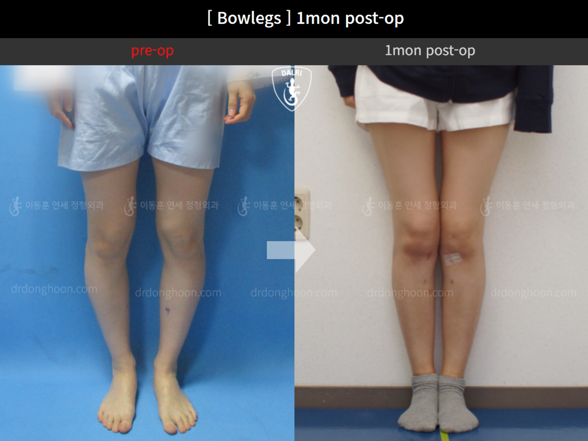[Bowlegs] 1mon post-op : Adult Bowlegs